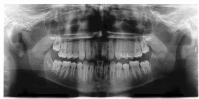 Panoramaröntgen – Zahnarzt Thilo Bracke
